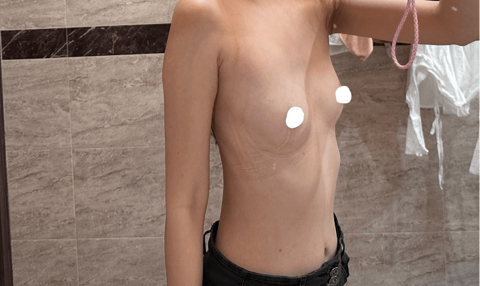 #分享 紙片人獨自升級！隆乳直上D奶 - B40 留言 | Dcard