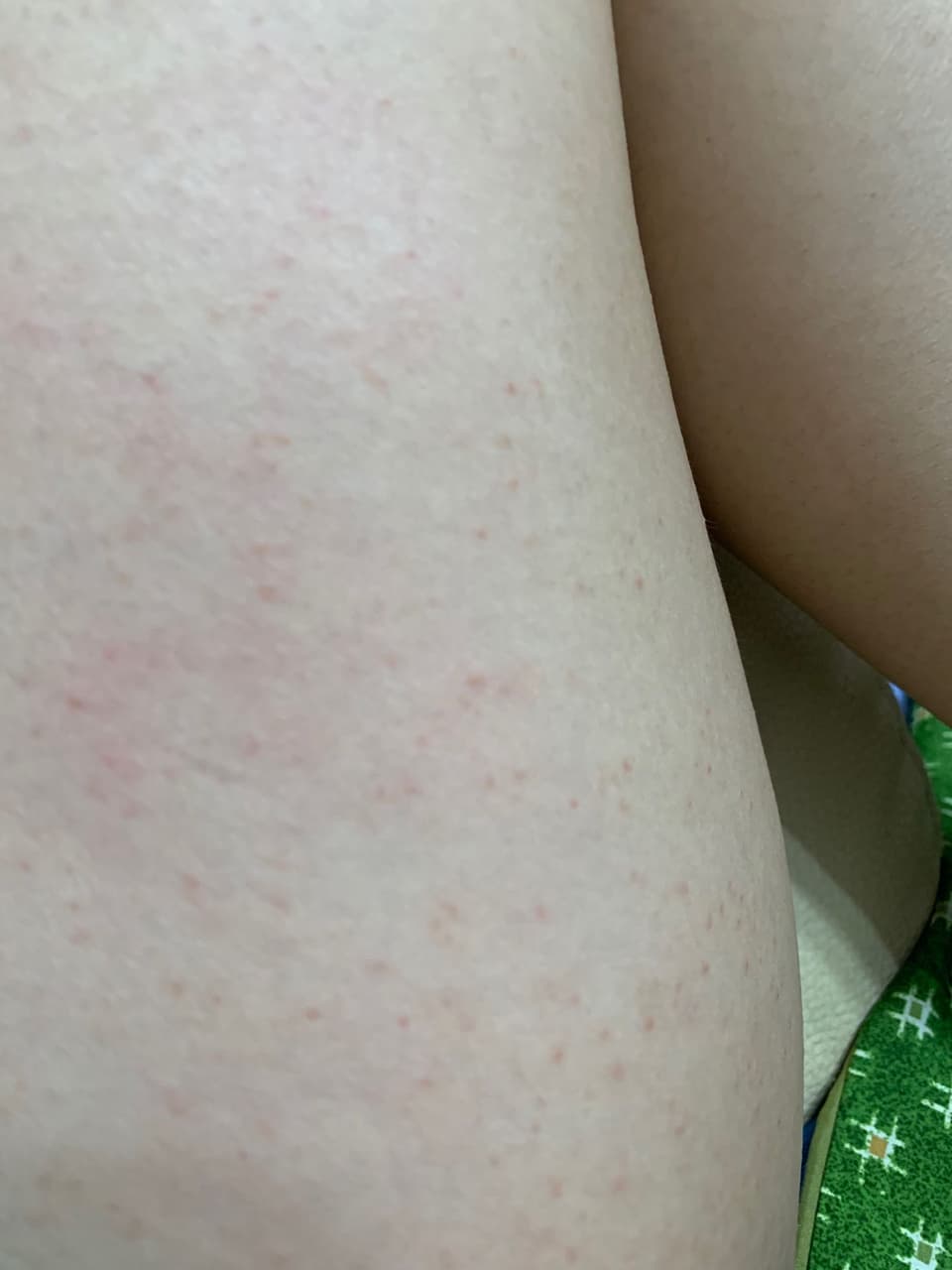 想請問是不是蕁麻疹 閒聊板 Dcard
