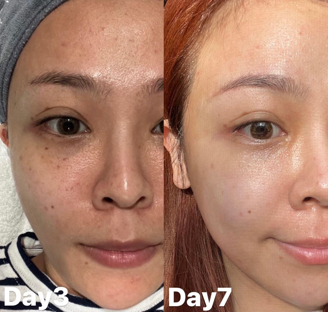 我的第一次水光針心得💦（有血慎入） #肝苦世代 - 自由媳 (@freeee_na) | Dcard