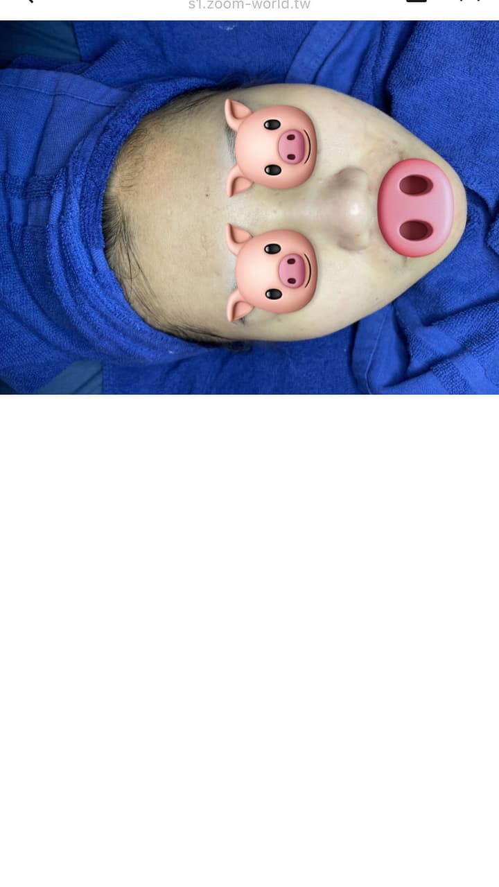 口服A酸大爆痘😵‍💫 - B90 留言 | Dcard