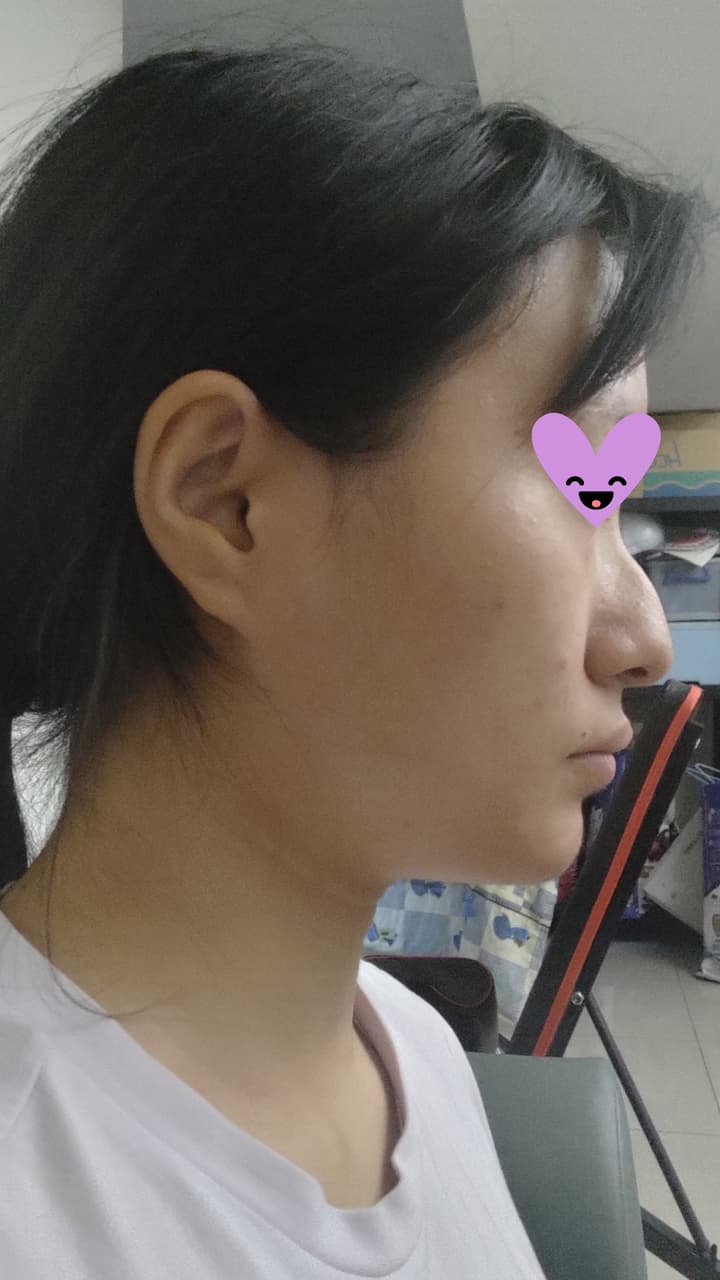 #請益 上唇 - 牙齒矯正板 | Dcard