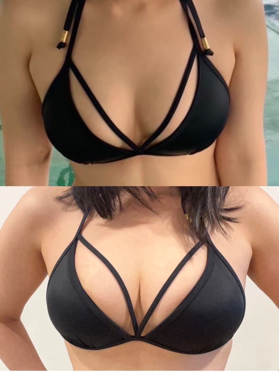 #分享 超有感的大小腿抽脂&PRP補胸 part 1 - 醫美板 | Dcard