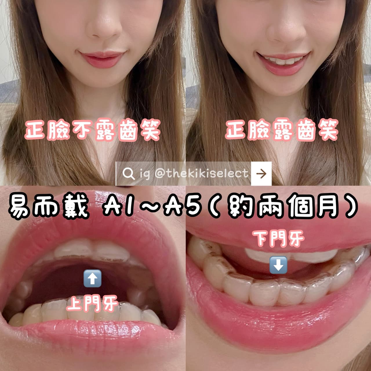 終於開始的矯正⼈⽣ 隱形牙套易⽽戴A1～A5 記錄分享 - 牙齒矯正板 | Dcard
