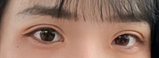 #分享 超後悔沒早點做的雙眼皮手術！ - B86-1 留言 | Dcard