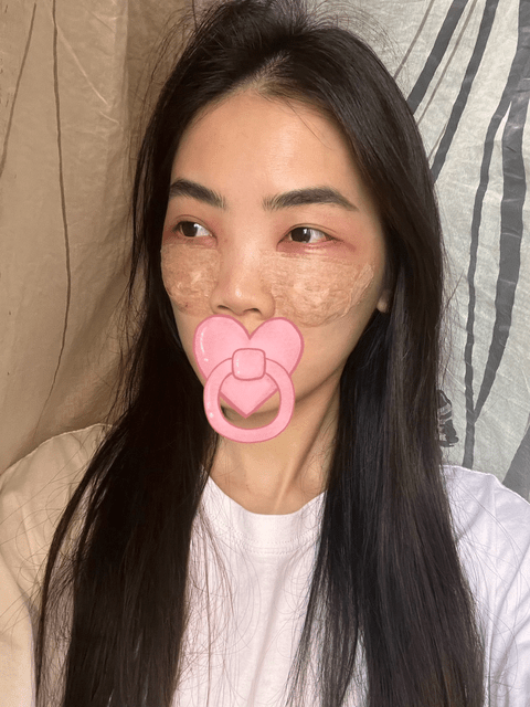 #分享 眼袋手術讓我煥然一新💝 - 醫美板 | Dcard