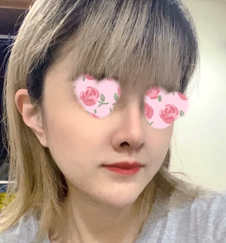 #分享 #隆鼻 蓮霧鼻進化史 - 醫美板 | Dcard