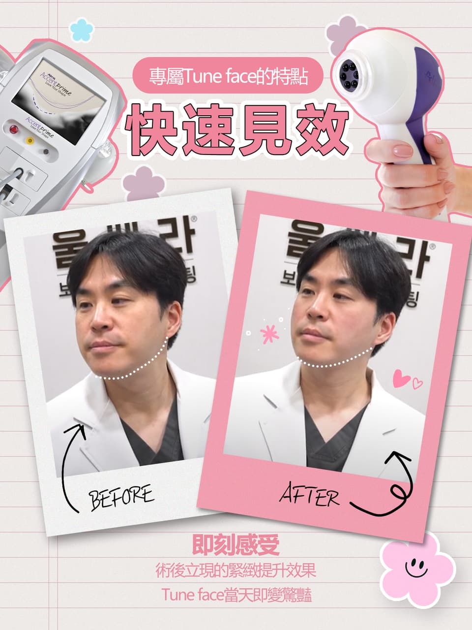 怕痛也能做的拉提？Tune Face 有什麼不一樣？ - jfeelclinic桔藝菲皮膚科 (@jfeelclinic_tw) | Dcard