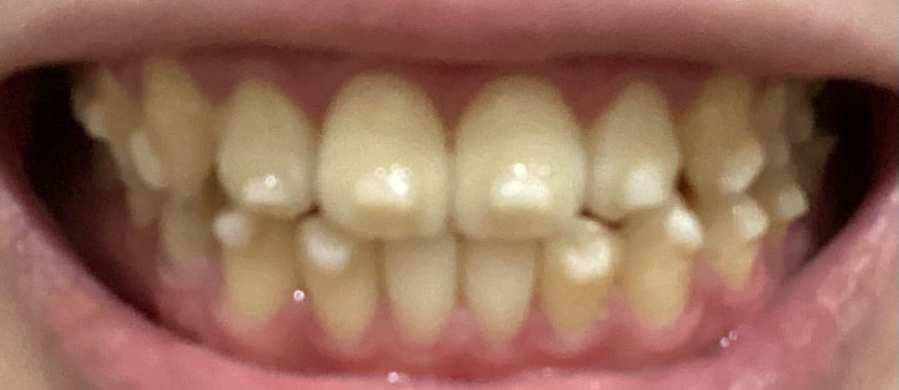 接近矯正尾聲，這樣夠了嗎，幫幫我 - 牙齒矯正板 | Dcard