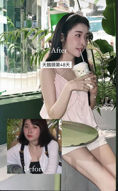 #分享 天鵝頸2.0術後一年分享 - 醫美板 | Dcard