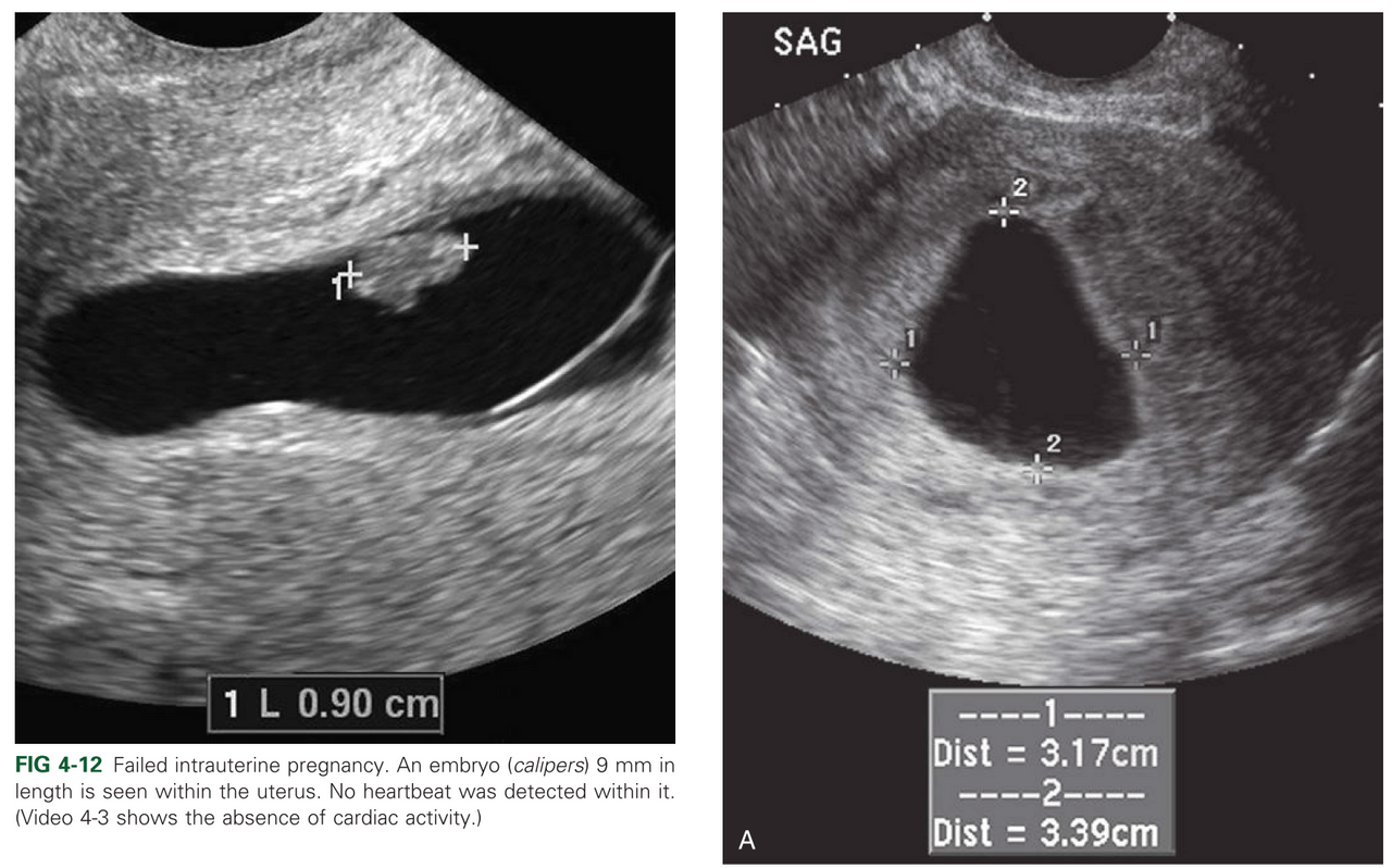 #懷孕 「醫生，我這顆是空包蛋嗎?」 淺談萎縮性胚胎(blighted ovum)以及子宮內懷孕失敗標準(failed IUP) - 親子板 ...