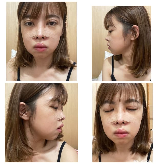 #分享 想了20幾年終於隆鼻跟縫雙眼皮了 - B44 留言 | Dcard