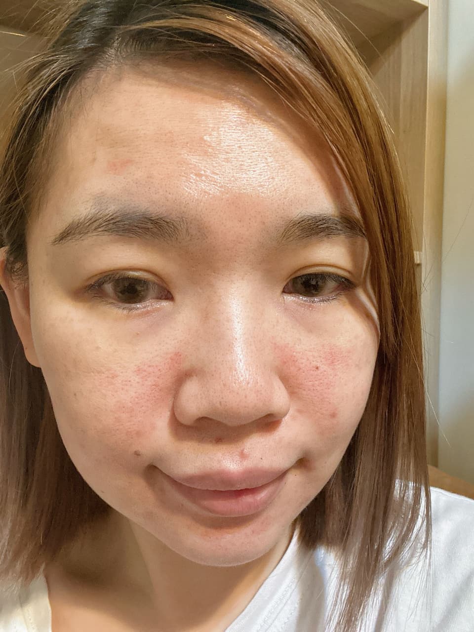 #分享 皮秒蜂巢真的很推 - 醫美板 | Dcard