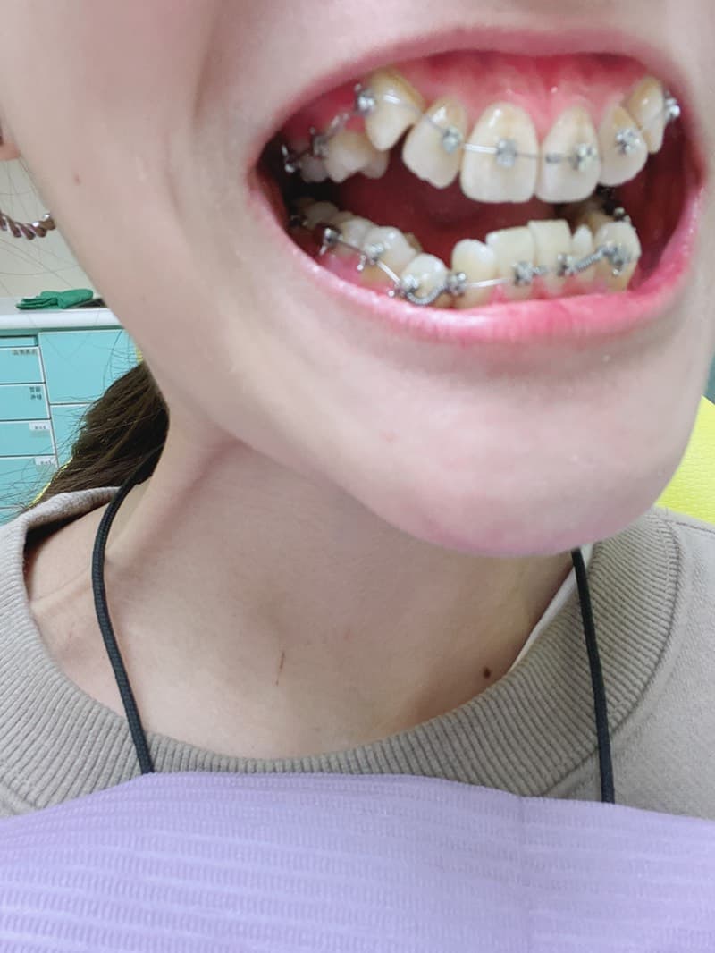 矯正牙齒全記錄！ - B256 留言 | Dcard