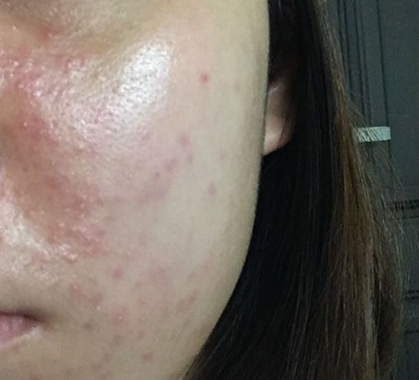 脂漏性問題真的好痛苦。 - B112 留言 | Dcard