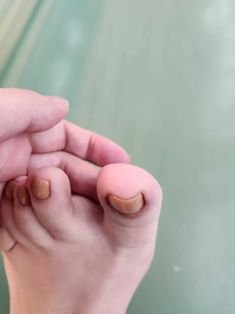 問題 請問甲床分離和捲甲（內含腳照） 美甲板 Dcard