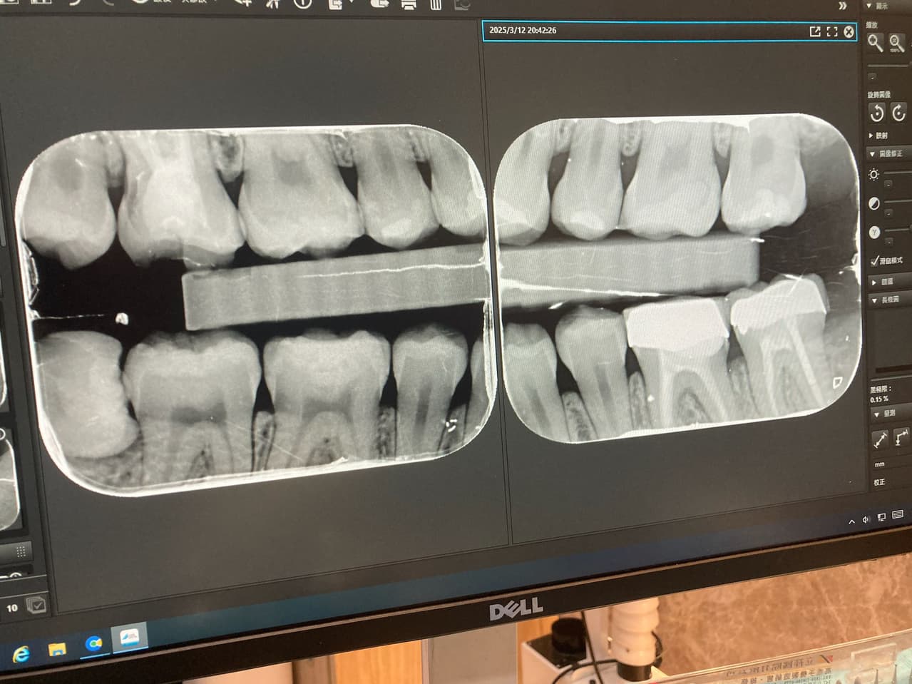我終於鼓起勇氣去拔智齒了 - 這邊這個優秀小青年 (@cl_20) | Dcard