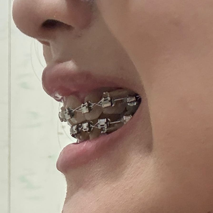 戴牙套前後&拆牙套請益>