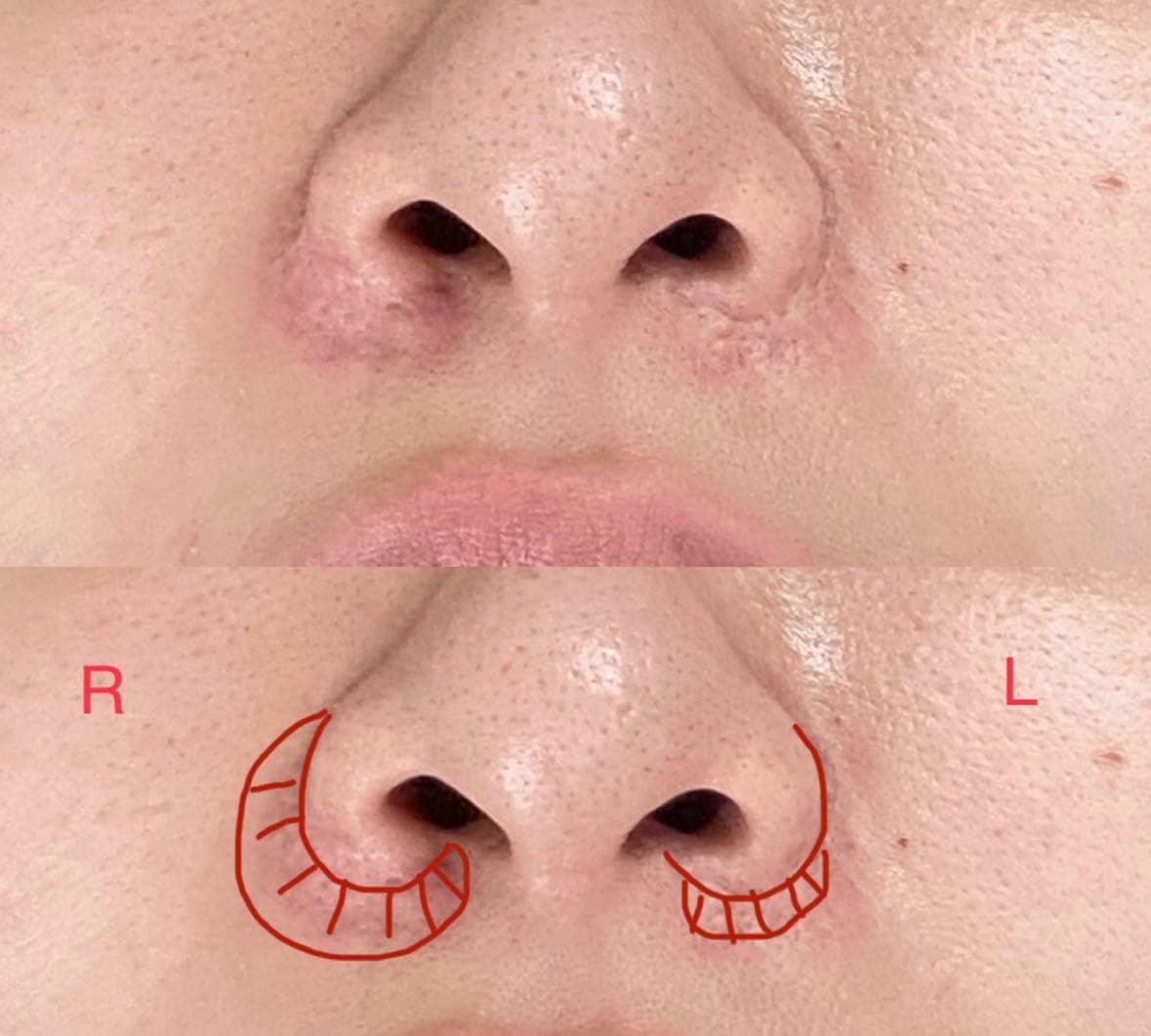 #分享 被毀掉的鼻翼終於救回來了 - B11-1 留言 | Dcard