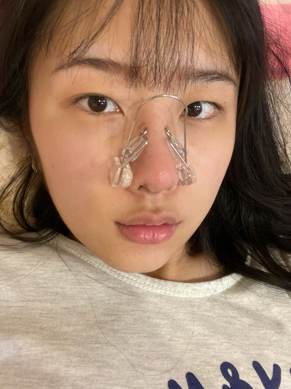 #分享 從朝天鼻變身韓系直鼻｜隆鼻完整心得分享 - 醫美板 | Dcard