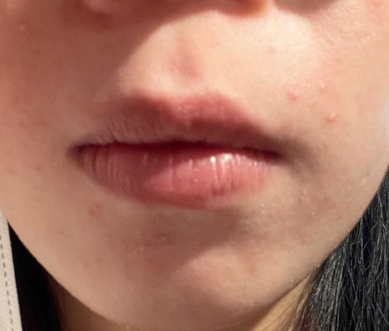 請益 這是什麼痘痘?一直長 超煩!! 美妝板 Dcard