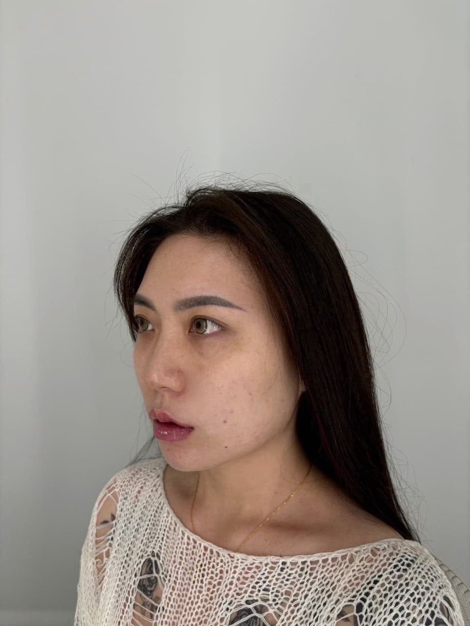 #分享 分享 玻尿酸豐唇+法令紋改善+口週年輕化 - 醫美板 | Dcard