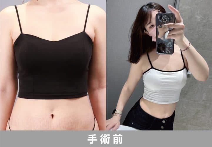 #案例分享 擺脫布袋奶 產後魔滴隆乳自信更加分 - 原美學診所 (@lorigine) | Dcard