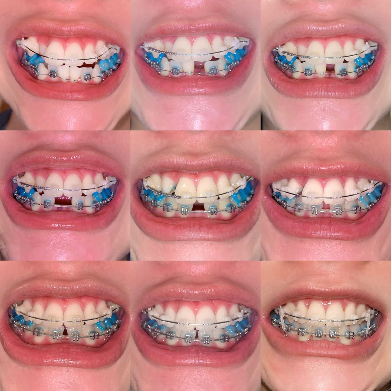 戴牙套是我這輩子最正確的決定！ - 牙齒矯正板 | Dcard