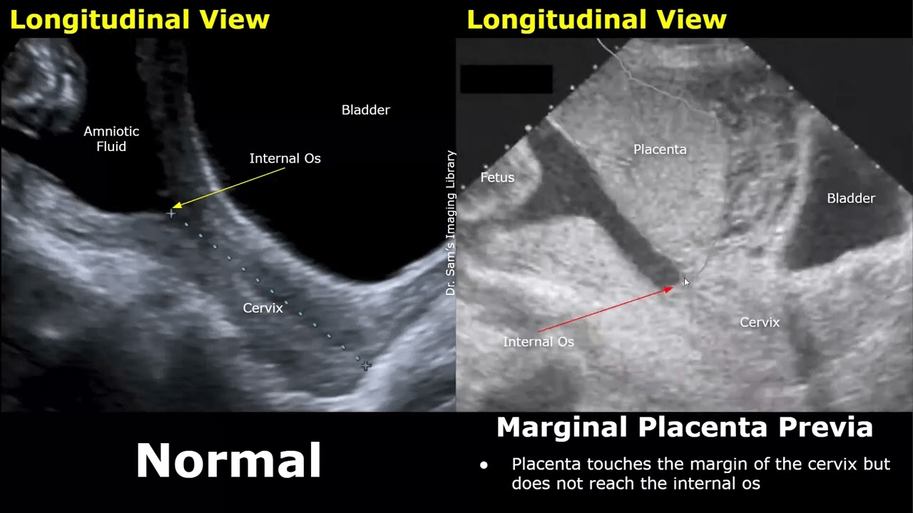 #懷孕 前置胎盤? 胎盤的位置 - 黃芃瑄醫師 • 婦產科 (@ogdr_huangph) | Dcard