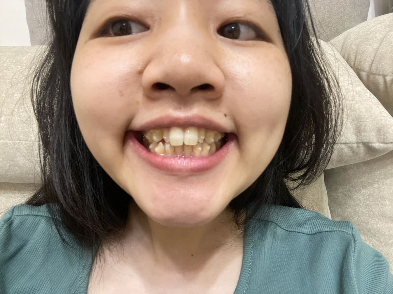 #分享 SOV數位隱形矯正畢業 - 牙齒矯正板 | Dcard