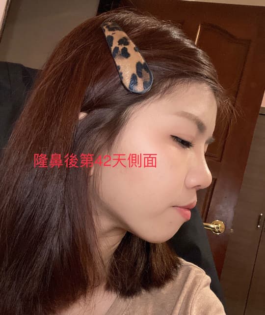 #分享 終於下定決心隆鼻啦！ - B183 留言 | Dcard