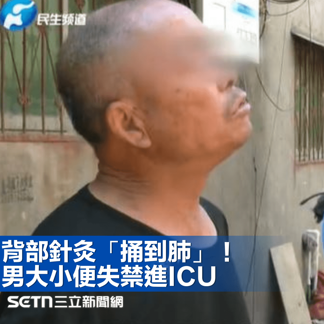 插太深了！背部針灸「整根捅到肺部」 男大小便失禁進ICU - SETN三立新聞網 (@setn54) | Dcard