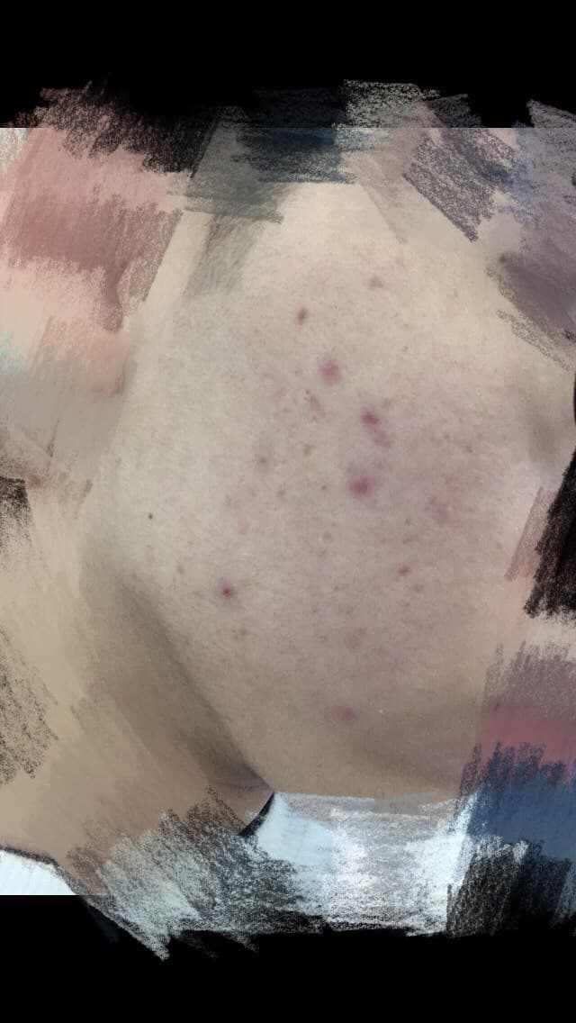 Prof TK杏仁酸濃度選擇 - 美妝板 | Dcard