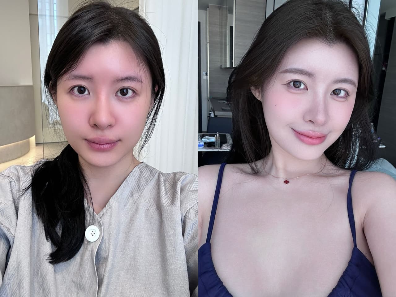 筋膜提升4D減齡術-滿三個月分享💙 - Coco Mu (@cocochubbupie) | Dcard