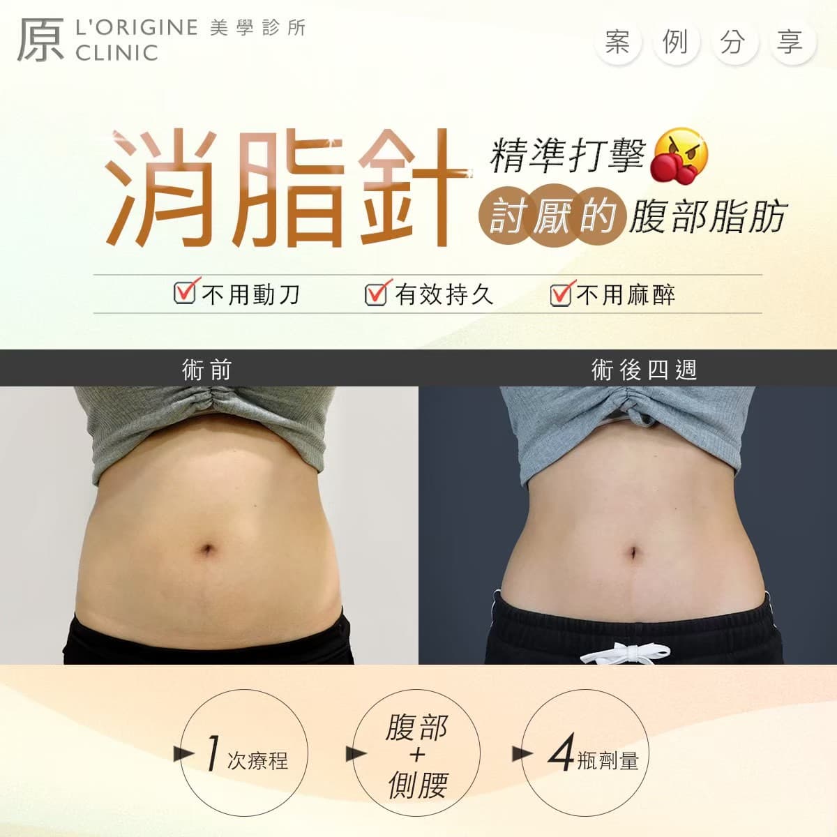 #案例分享 拒當小腹婆 不動刀輕鬆雕塑腰腹曲線 - 原美學診所 (@lorigine) | Dcard