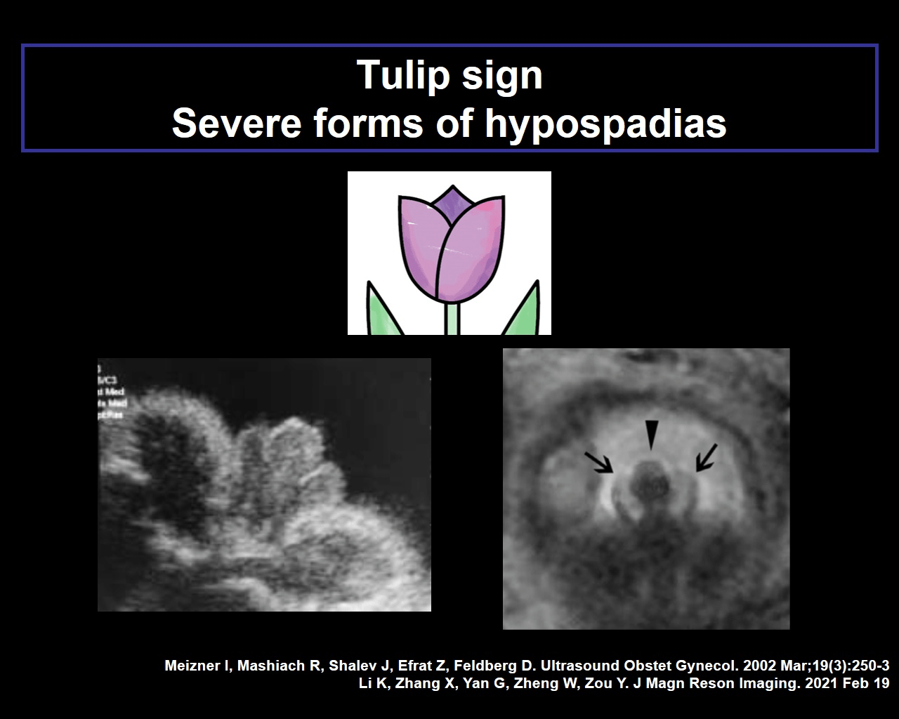 #懷孕 淺談尿道下裂(Hypospadias) - 親子板 | Dcard