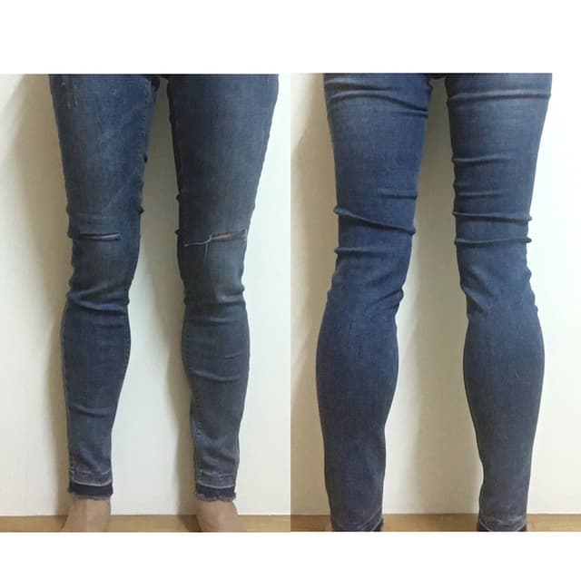 #分享 瘦小腿手術（更手術後第37天 - B259 留言 | Dcard