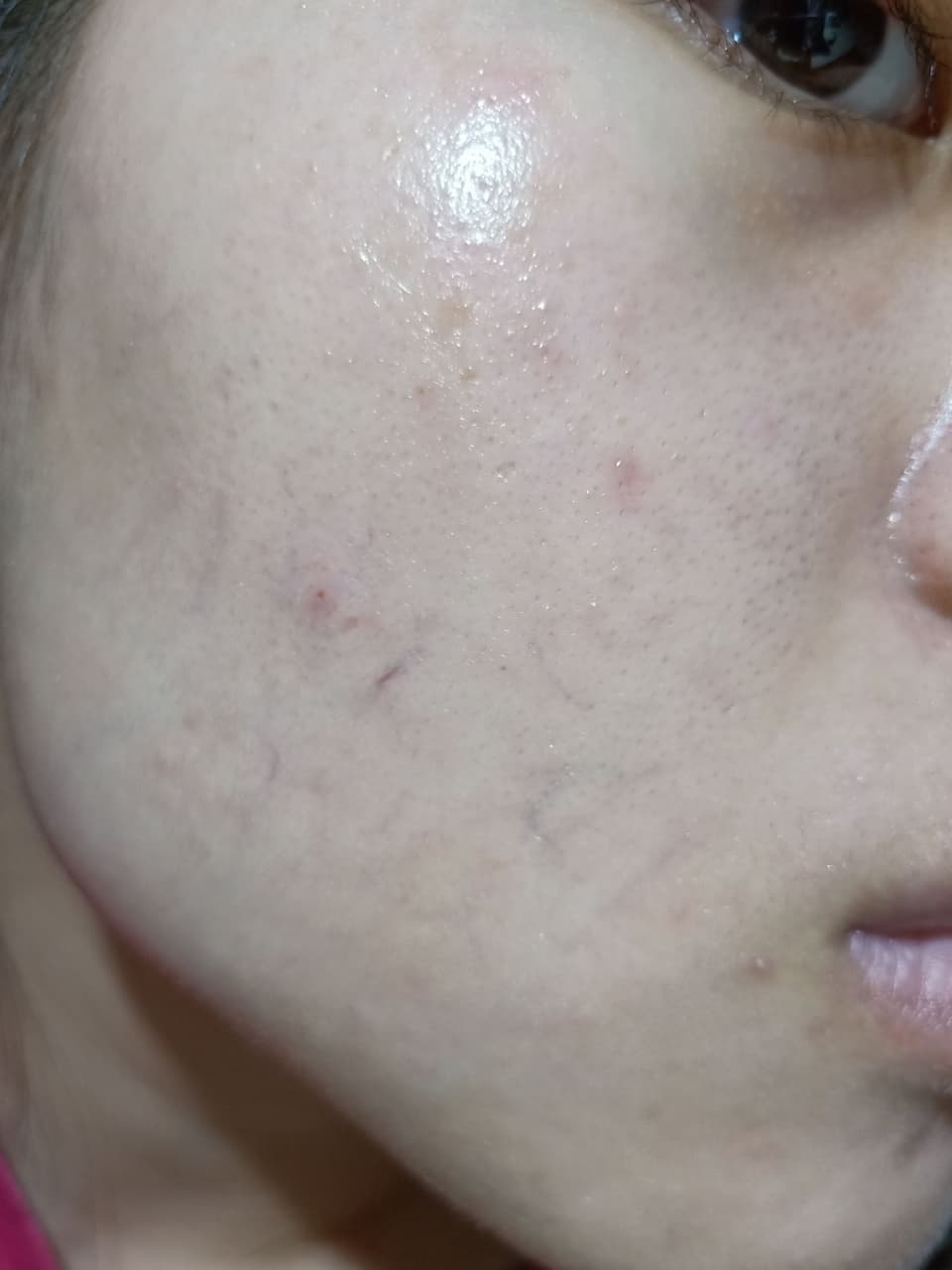 🏆獎金一萬元💥理膚寶水戰隊集合💥生活從此不再NG 立刻分享你的抗「痘」去「粉」心得or「粉」「痘」趣創意文案！讓全站卡友看到你👏！ - B272 留言 | Dcard