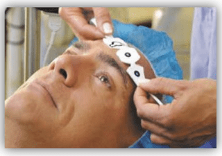 #分享 麻醉深度偵測儀(BIS+DSA) - 醫美板 | Dcard