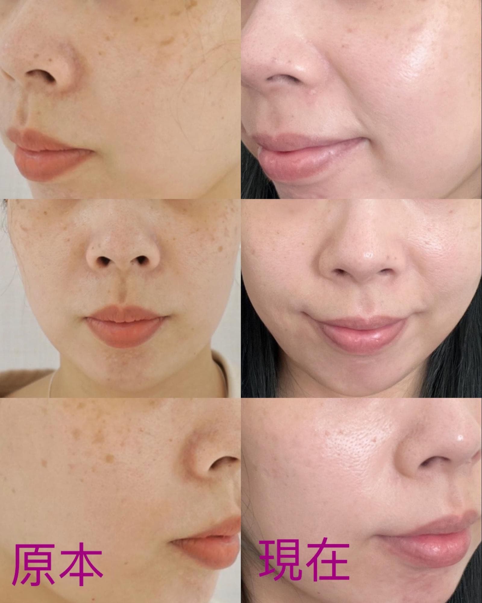 #分享 從淨膚雷射畢業進階到光秒 - 醫美板 | Dcard