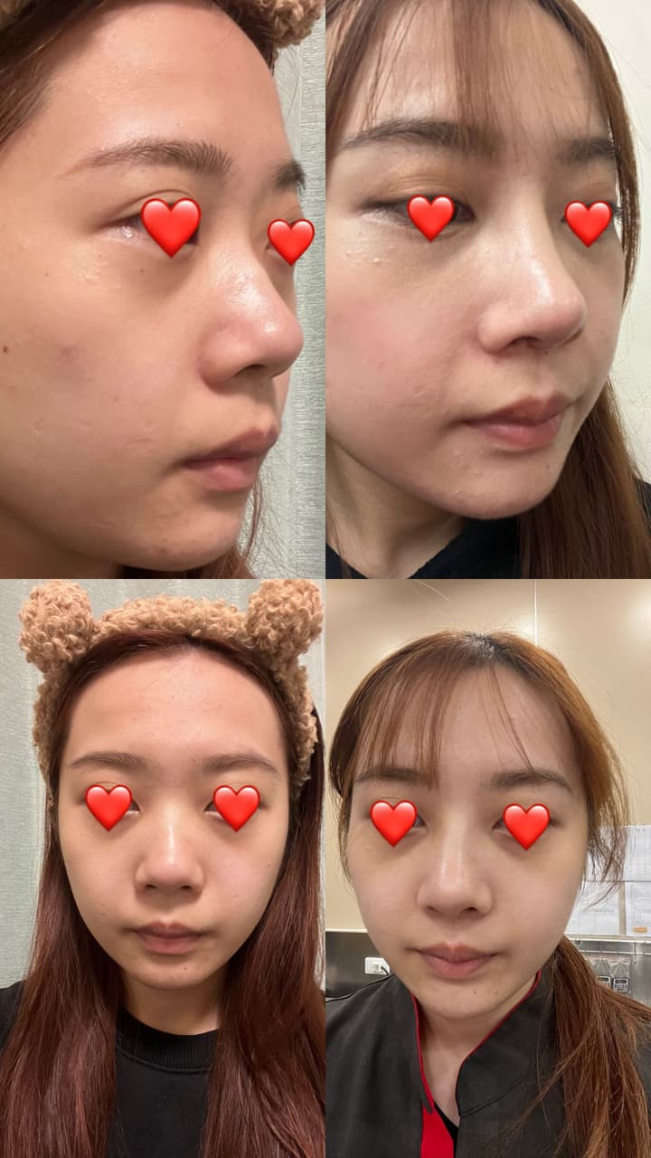 #分享 20y去三段式隆鼻？？？ - 醫美板 | Dcard