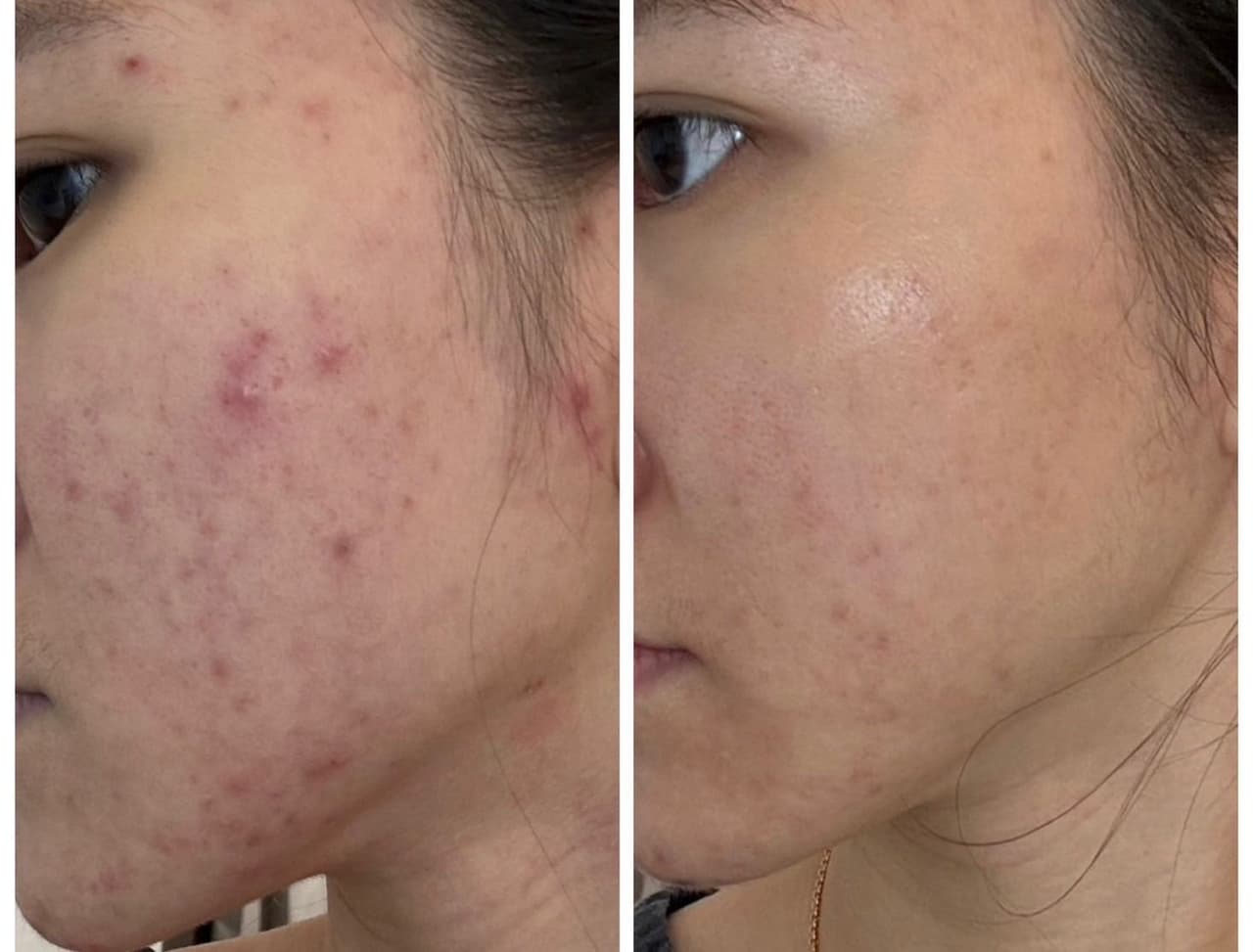 徵模特 徵模特 徵麻豆 做臉清粉刺 台中南屯 美容美體板 Dcard