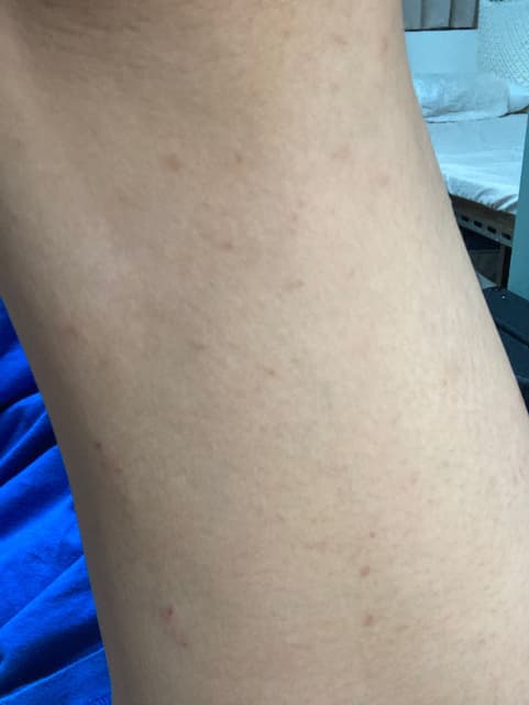 發問 請問 有人知道這是被什麼蟲咬到ㄇ? 問答板 Dcard