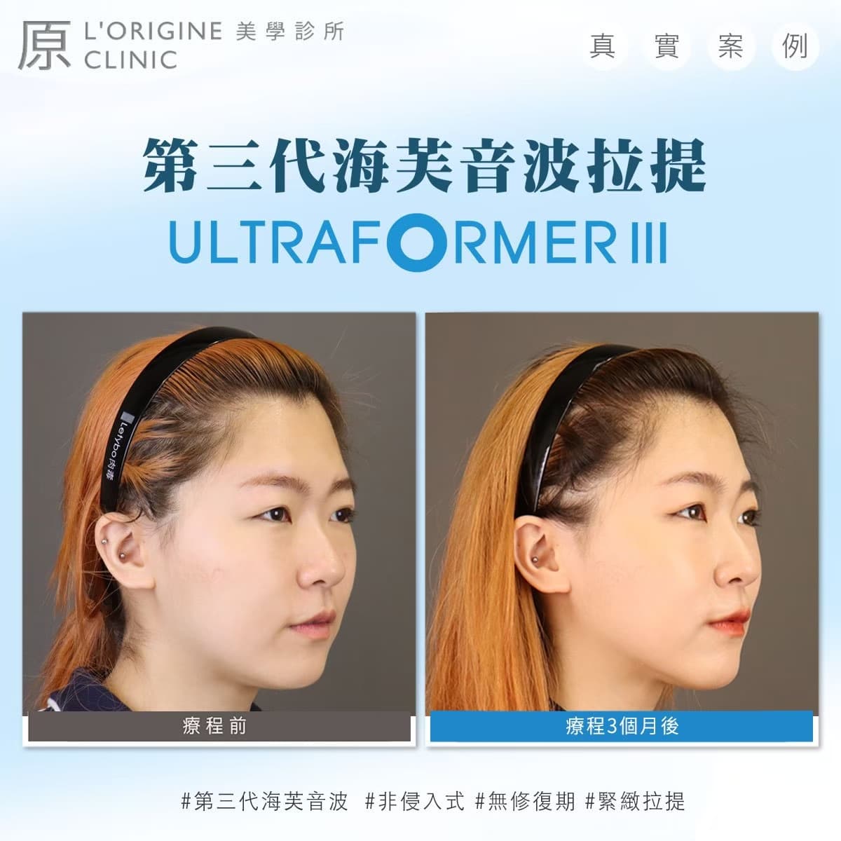 #知識 體重減輕了皮膚卻變鬆？ - 原美學診所 (@lorigine) | Dcard