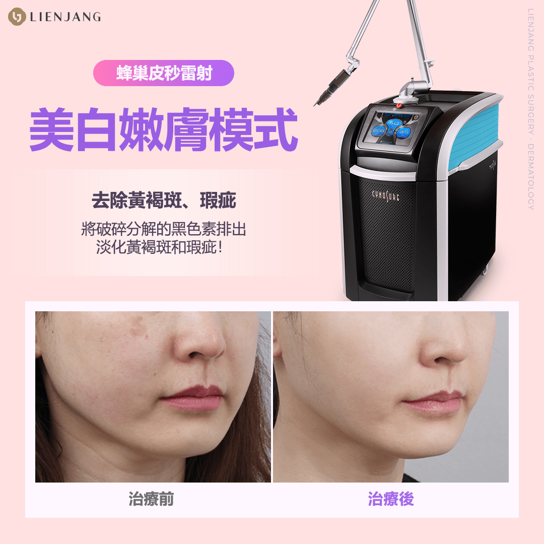 皮秒雷射機種介紹與顧客真實心得分享 - 韓國醫美 麗妍常 (@lienjang) | Dcard