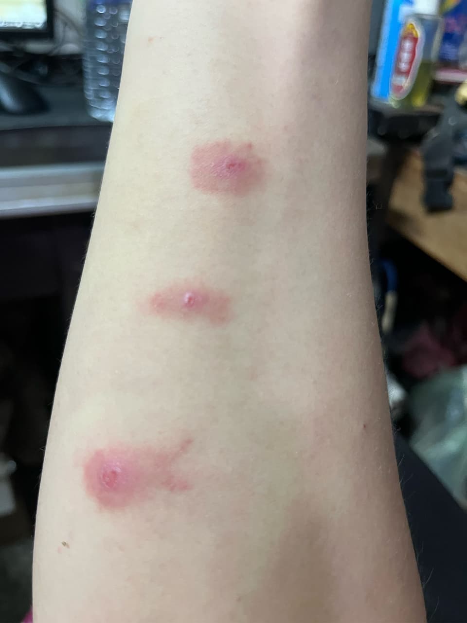 請問有人知道這是什麼症狀嗎？ 還是是過敏 從心到大都會突然一陣子就長這些東西 前期還會留一點點組織液 看醫生也是短期擦一下藥而已🥲 閒聊板 Dcard