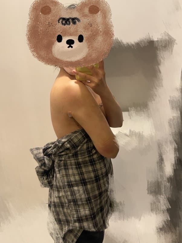 分享想要的纖細手臂 - 晶美整形 (@skin1000) | Dcard