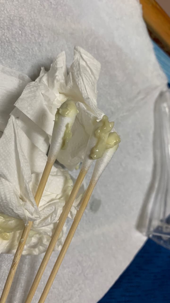 戰鬥半年多白色念珠菌 有效治癒分享 (2025/7起停更、延遲回覆，請見諒) - B110 留言 | Dcard