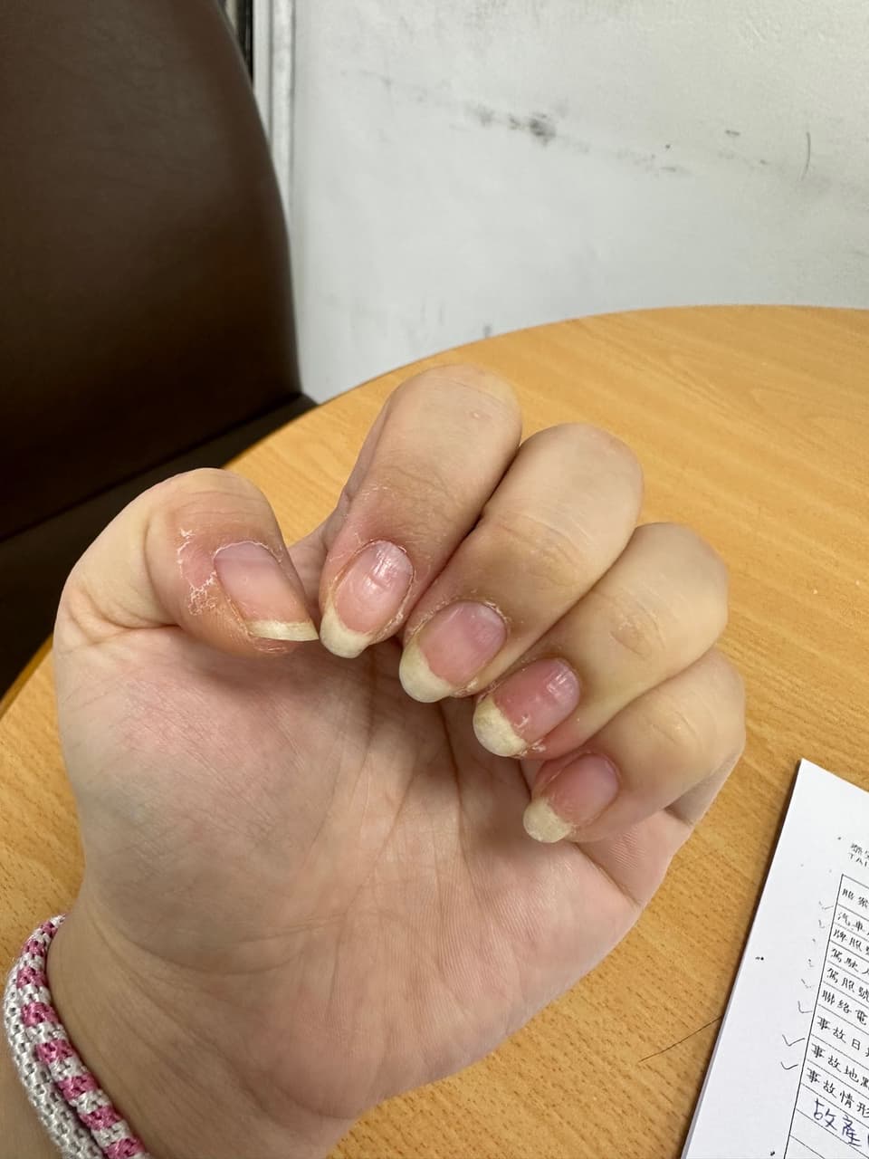 問題 詢問手這樣是怎麼回事? 美甲板 Dcard