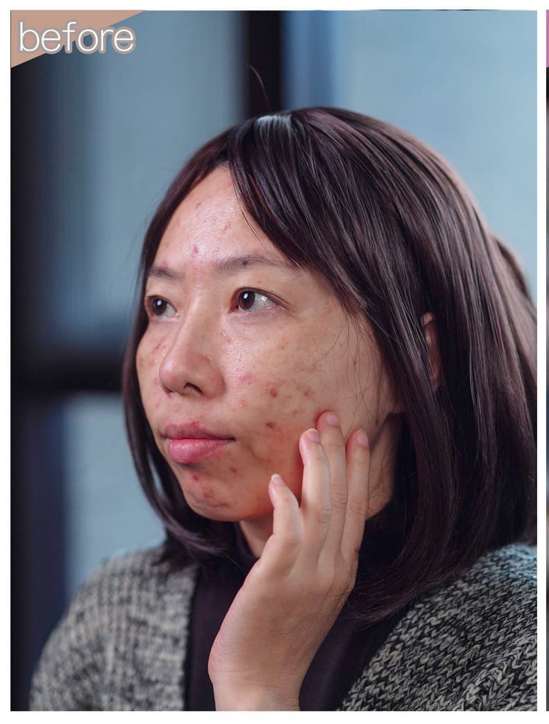 告別痘痘、蠟黃等肌膚問題 邁向素顏健康美肌 - 十分肌膚管理 (@skin_beauty_10) | Dcard