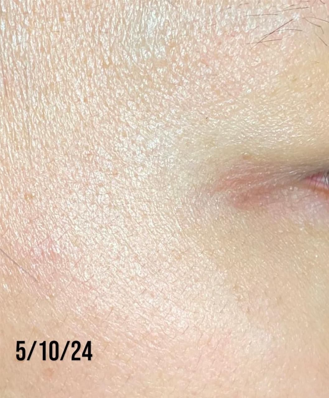 一顆老青春痘，讓我挖掘出 CBD + NMN 延緩老化的功效，膠原蛋白免了拉！ - 閒聊板 | Dcard